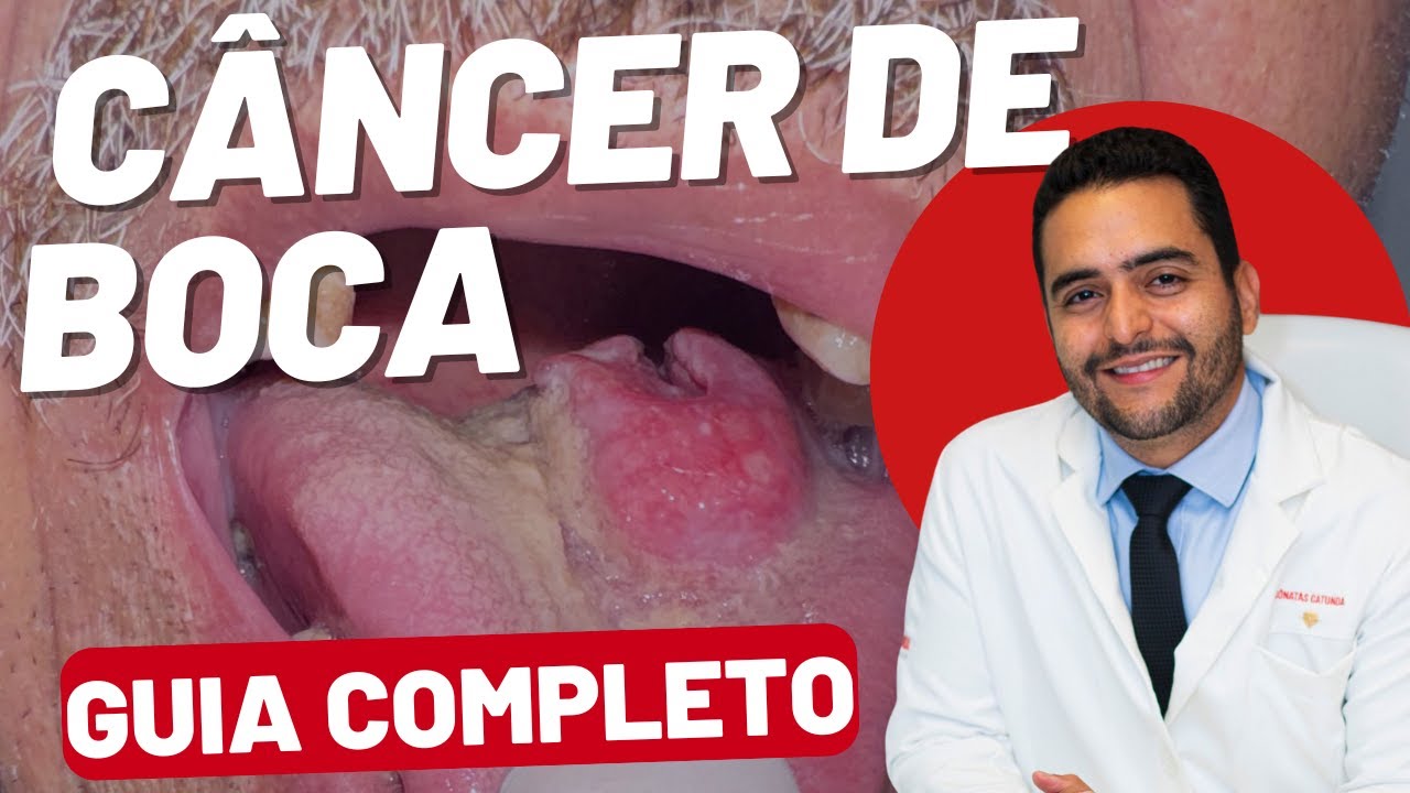Câncer de Boca: Fotos de Casos, Sintomas, Diagnóstico, Tratamento - YouTube