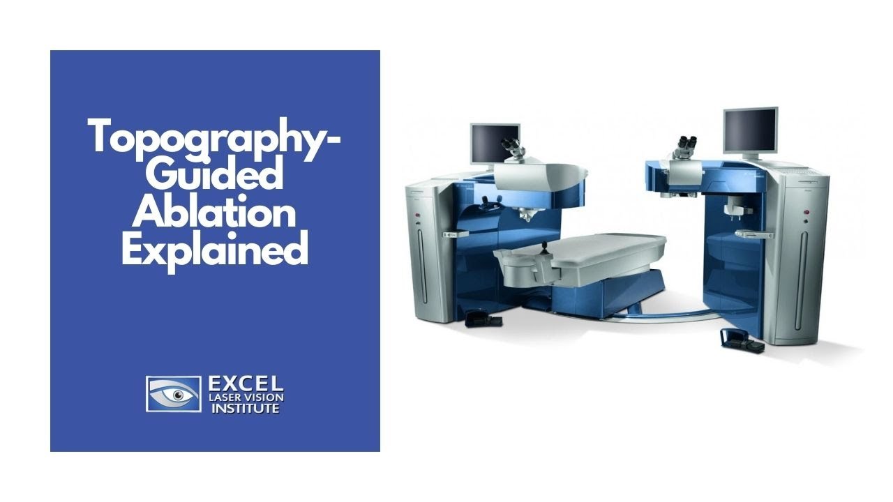 Topography-Guided Ablation Explained - YouTube