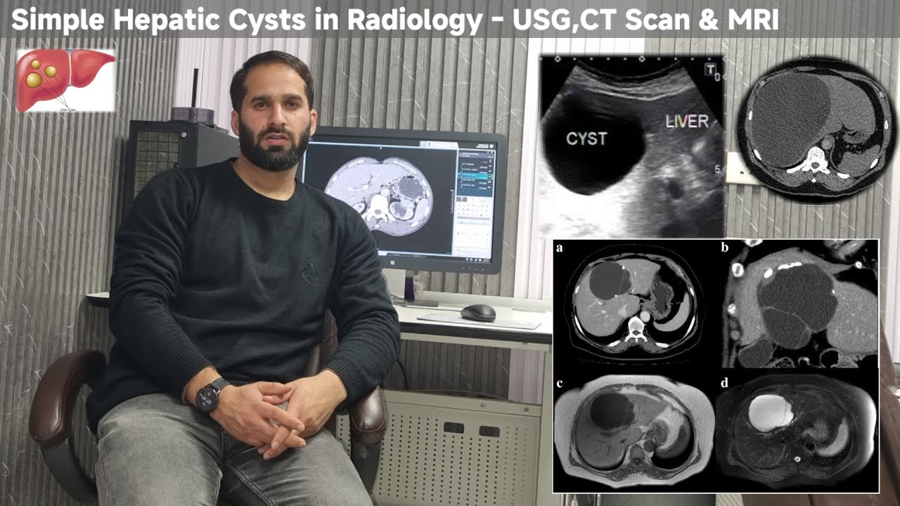 Simple Hepatic Cyst in Radiology | USG,CT Scan & MRI | By Anis Qureshi ...
