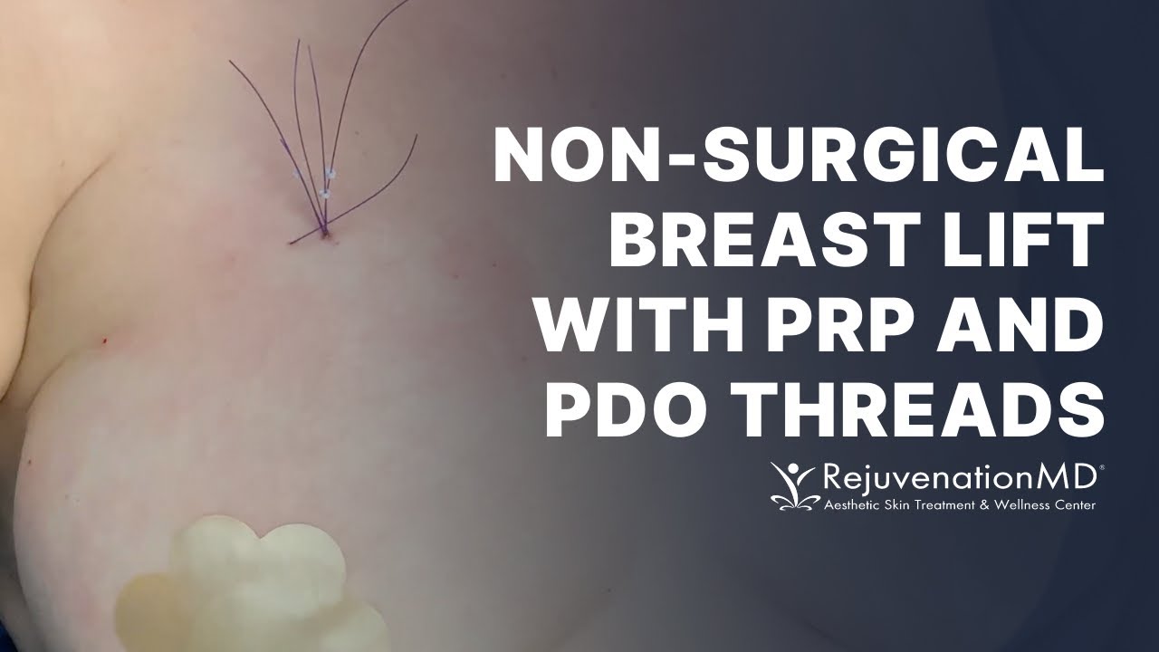 Beautiful, Non-Surgical Breast Enhancement | PRP and PDO Thread Breast Lift - YouTube