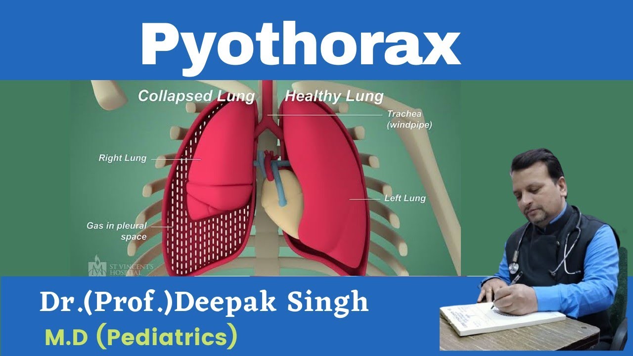 Pyothorax # Deepak PD Singh - YouTube