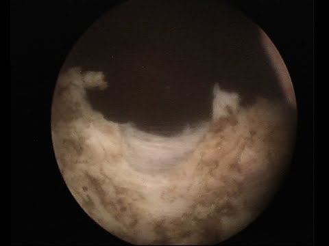 Bladder neck resection by Thulium fibre laser - YouTube