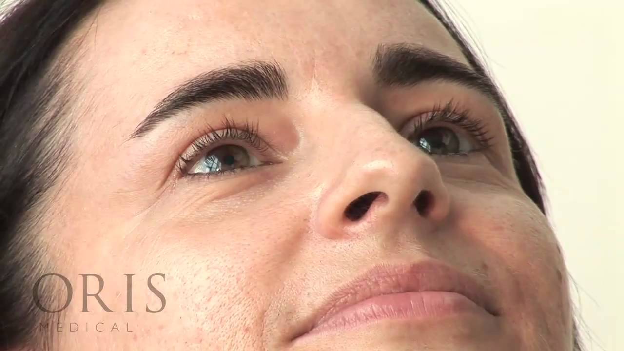 Botox training - Crows Feet - Oris Medical - YouTube