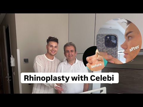 Rhinoplasty with SABAN CELEBI - full experience - YouTube