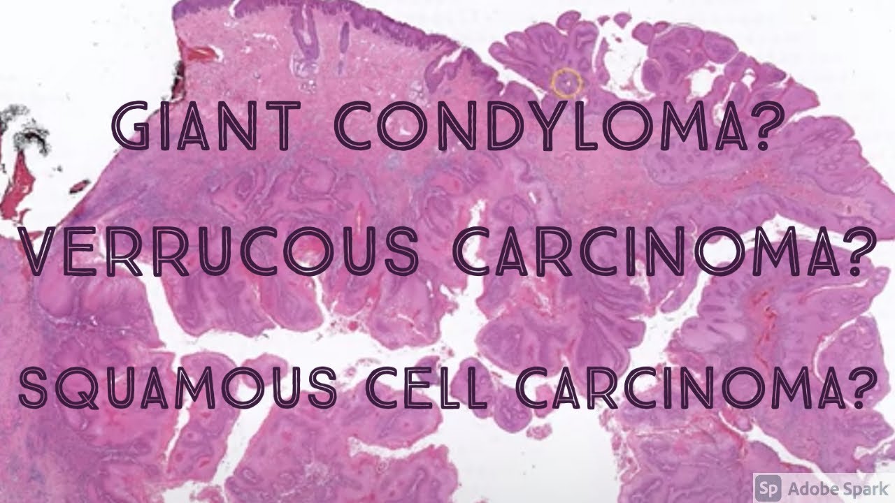 Giant Condyloma vs Squamous Cell Carcinoma vs Verrucous Carcinoma ...