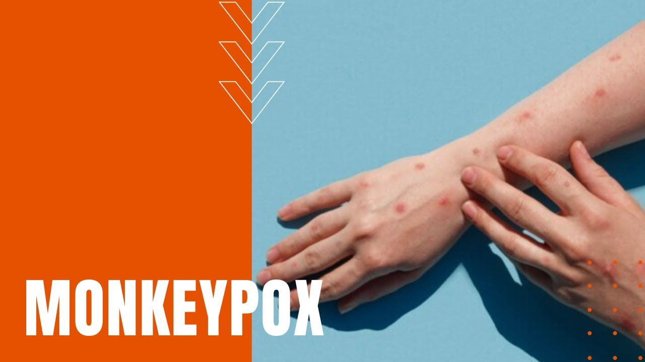 History of Monkeypox - YouTube