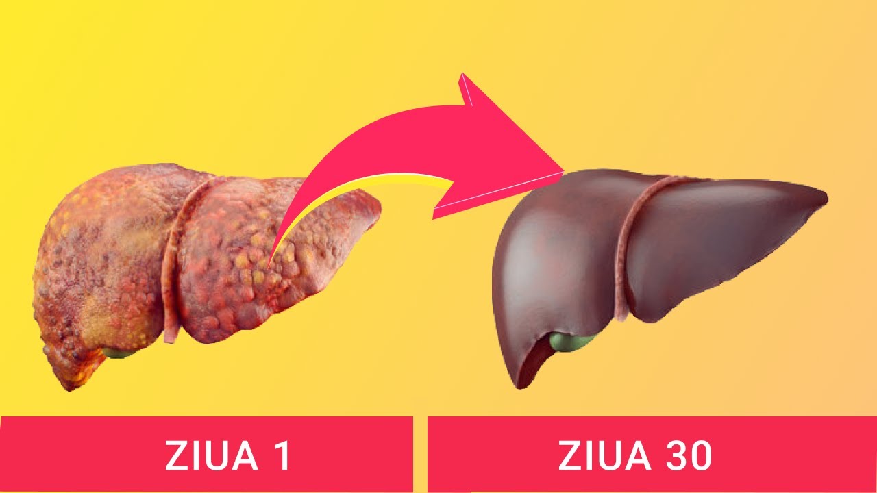 Suferi de ficat gras? Vezi top alimente si remedii benefice ficatului ...