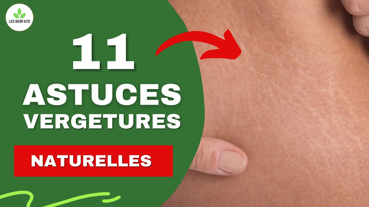 VERGETURES: 11 ASTUCES POUR LES ÉLIMINER NATURELLEMENT ET RAPIDEMENT ...