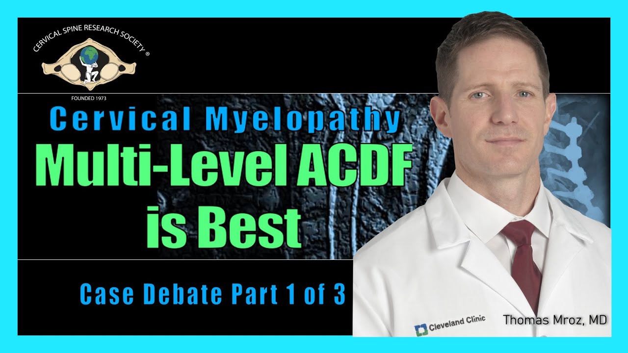 Cervical Myelopathy: Multi-Level ACDF Case Debate 1 of 3 - Dr. Thomas ...