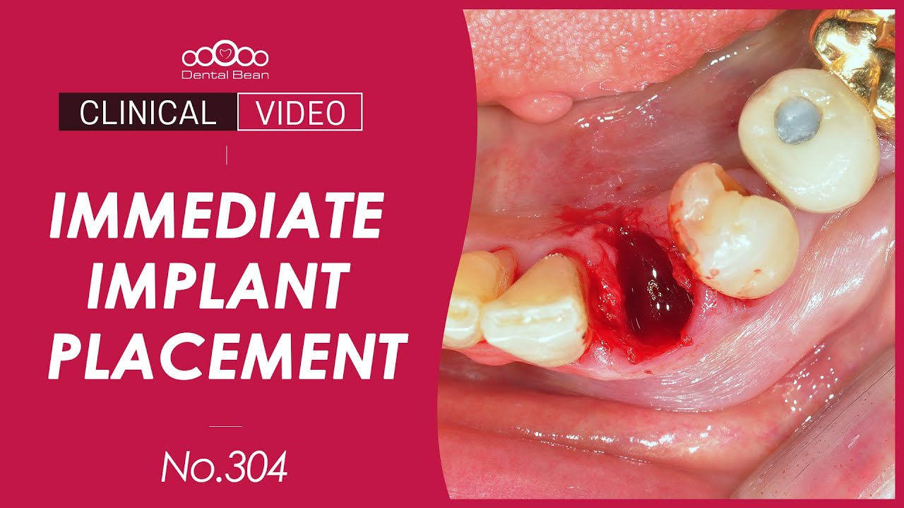 Immediate Implant Placement on Lower Canine [Dr. Kim Jaeyoon] - YouTube