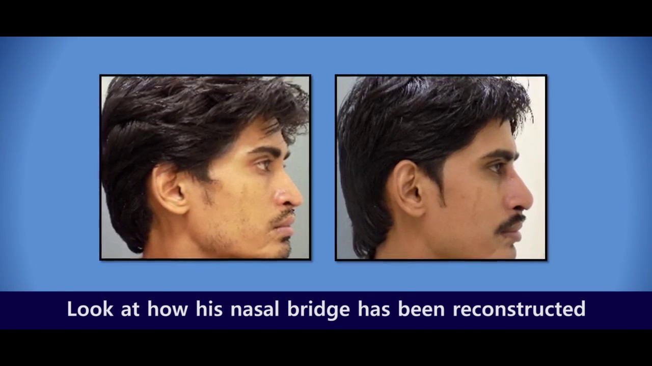 How Damage Nose is reconstructed using Rib cartilage after Major ...
