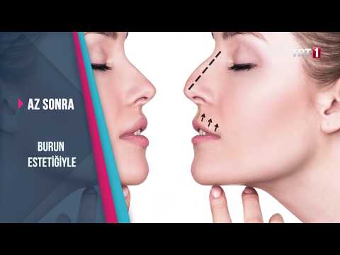 Doktor Geldi 30. Bölüm (20 Ekim 2017) | Çikolata Kisti, Burun Estetiği