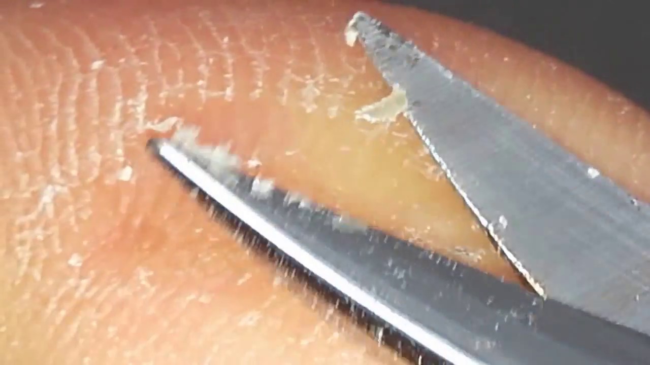 How to remove callus (Hard foot skin)#4 - YouTube