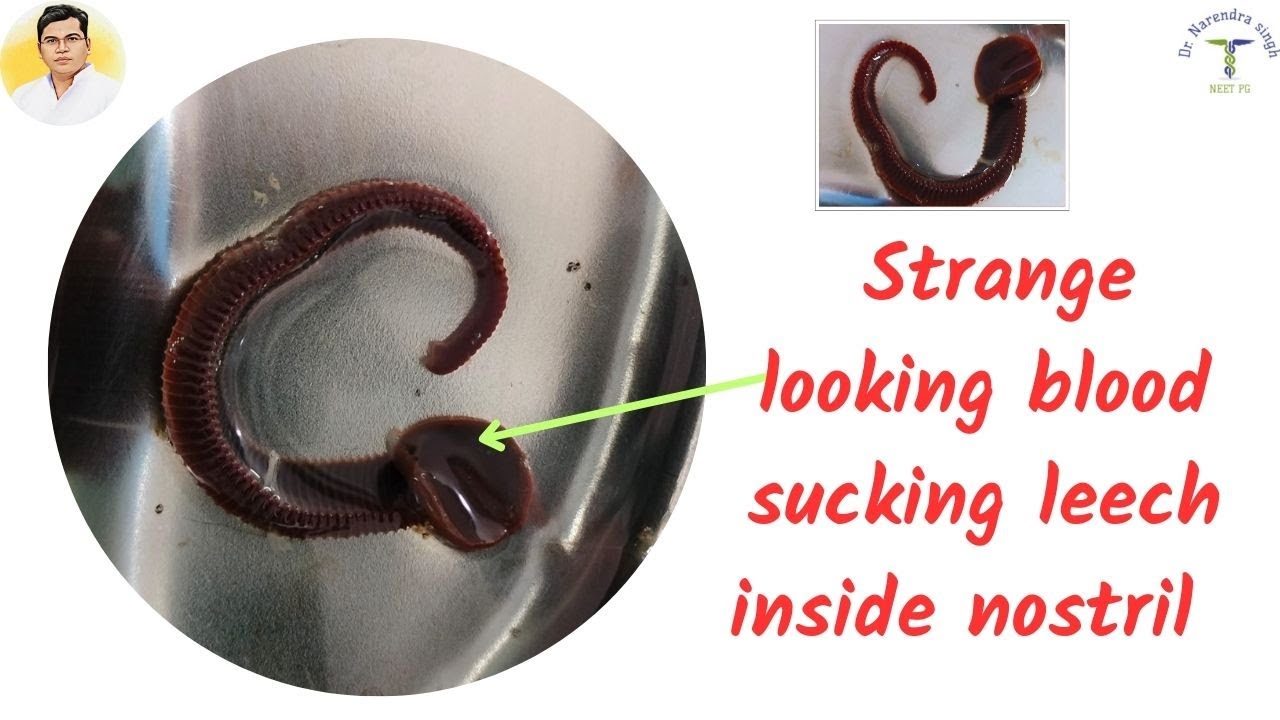 Horrifying Blood Sucking Huge Leech Inside Nostril - YouTube