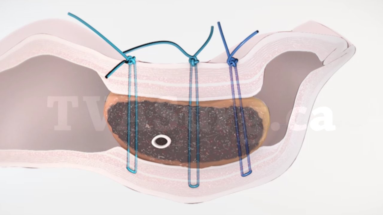 Blumgart-style Pancreaticojejunostomy - YouTube