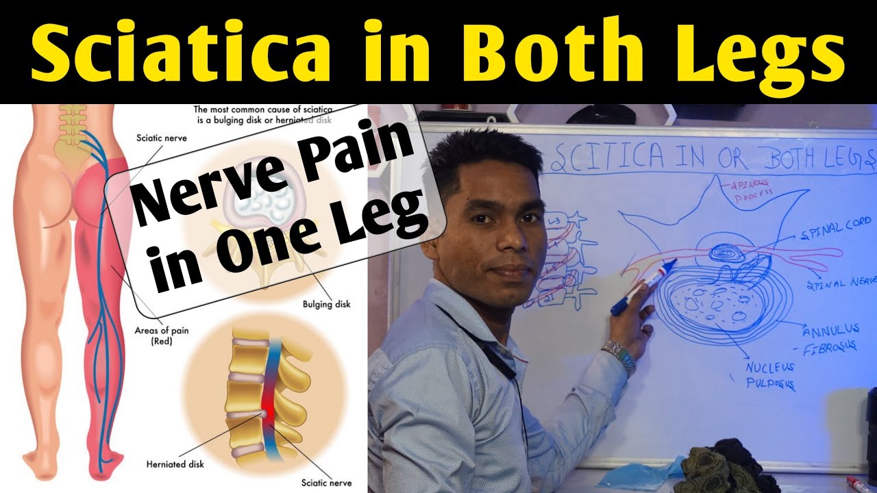 Nerve Compression in Leg, Foraminal stenosis, Nerve Pain in leg ...