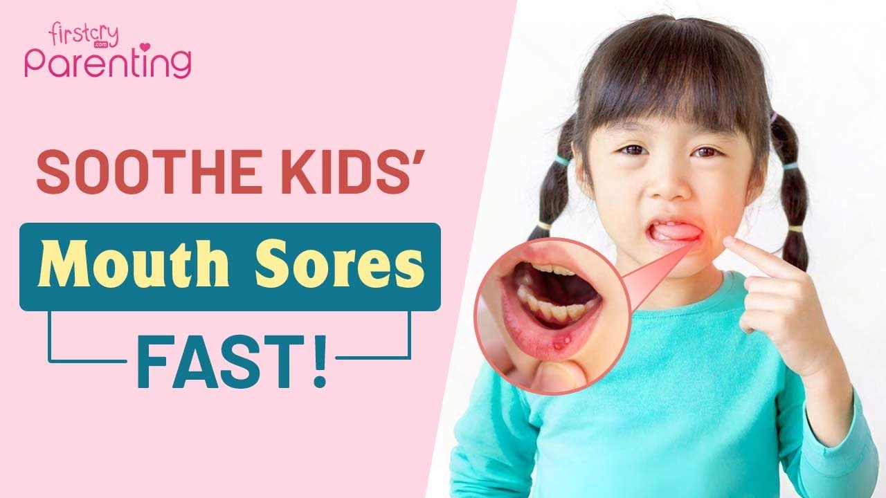 12 Best Home Remedies for Mouth Ulcers in Kids | Mouth Ulcer Home ...
