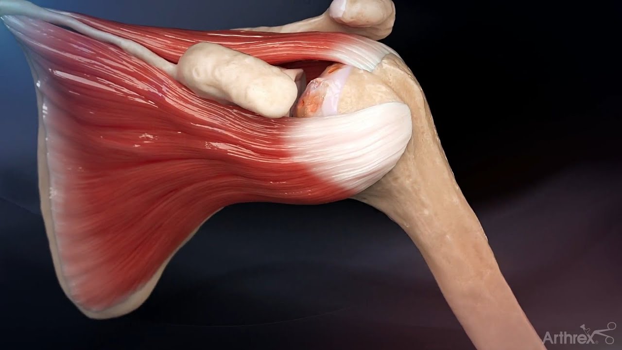 FiberTape® Tendon Compression Bridge Technique - YouTube