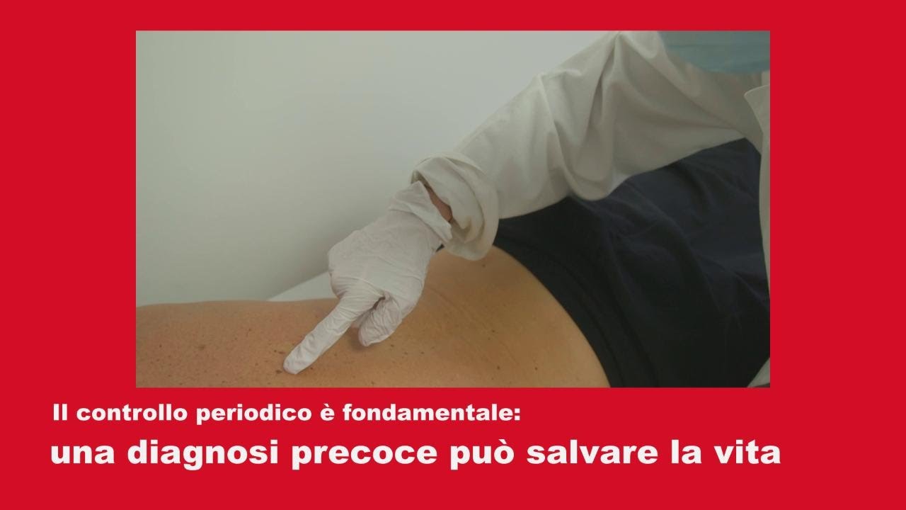 Come si fa a riconoscere un neo sospetto: cosa e dove contrallare - YouTube