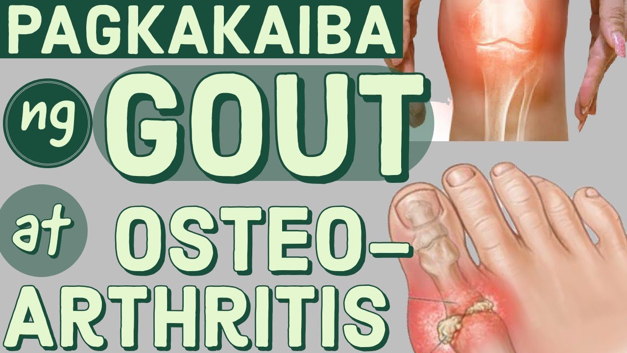 PAGKAKAIBA ng Gout at Osteo-Arthritis: Alamin - Payo ni Doc Willie Ong ...