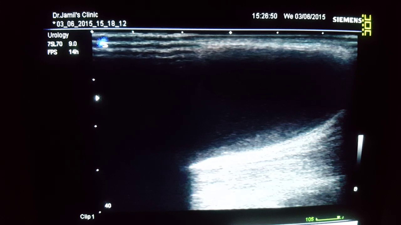 Baker's Cyst Ultrasound - YouTube
