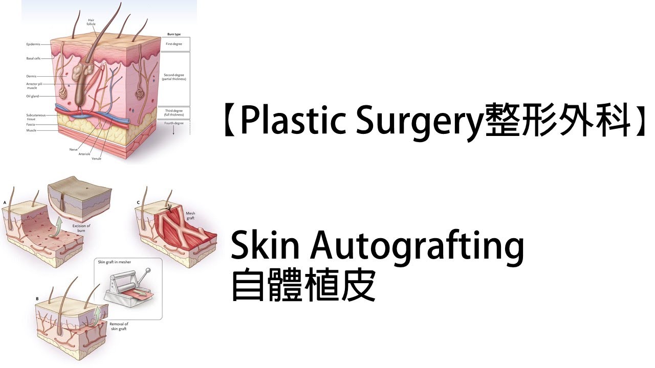 【Plastic Surgery整形外科】Skin Autografting自體植皮 - YouTube