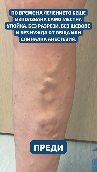 Kлиничен случай на 51 г жена с хронична венозна болест и изявени