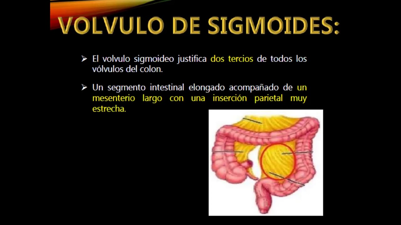 Vólvulo de Sigma - YouTube