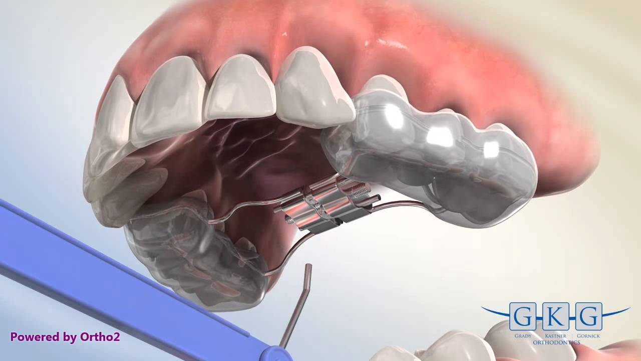 RPE Bonded - YouTube