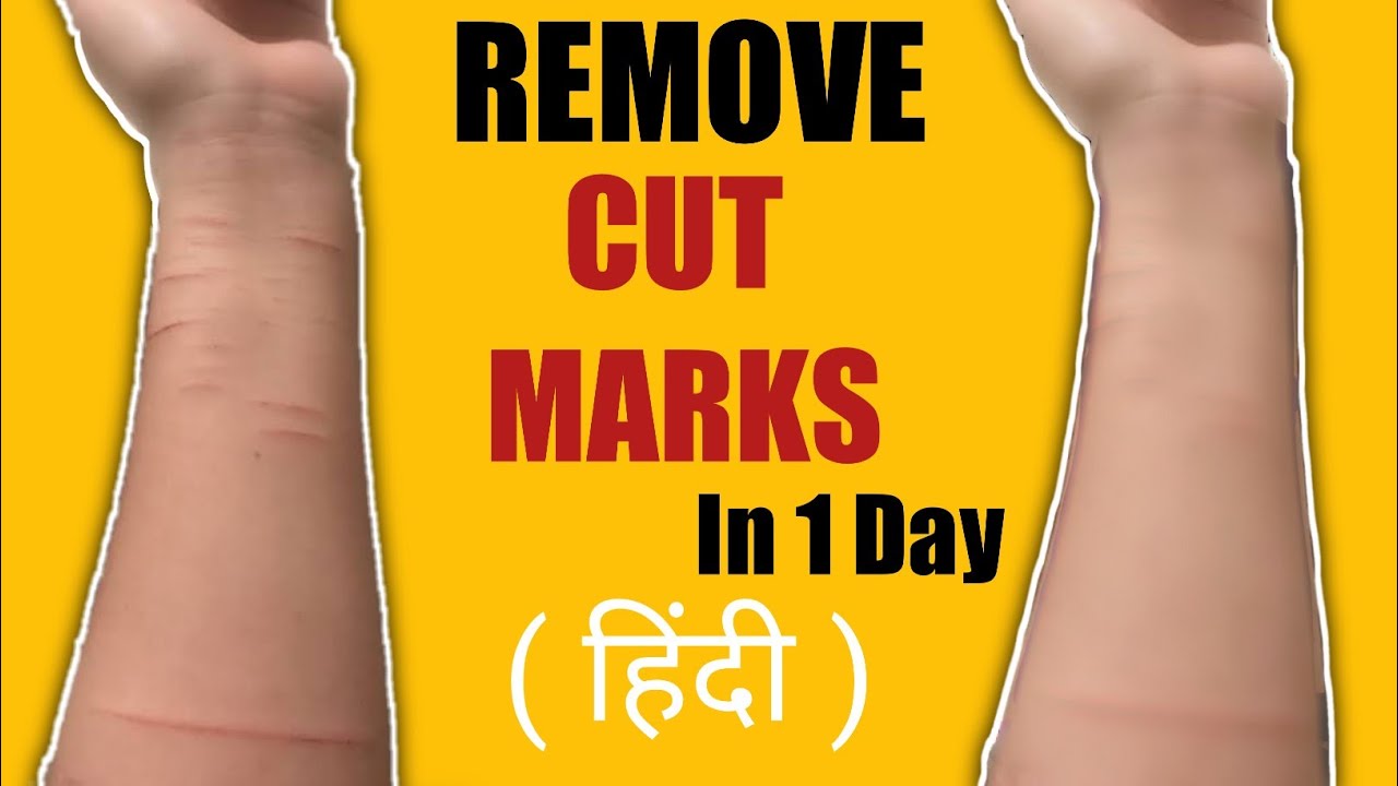 How To Remove Cut Marks From Hand Naturally Remove Scars From Hand How To Remove Cut Marks From Hand Naturally Remove Scars From Hand