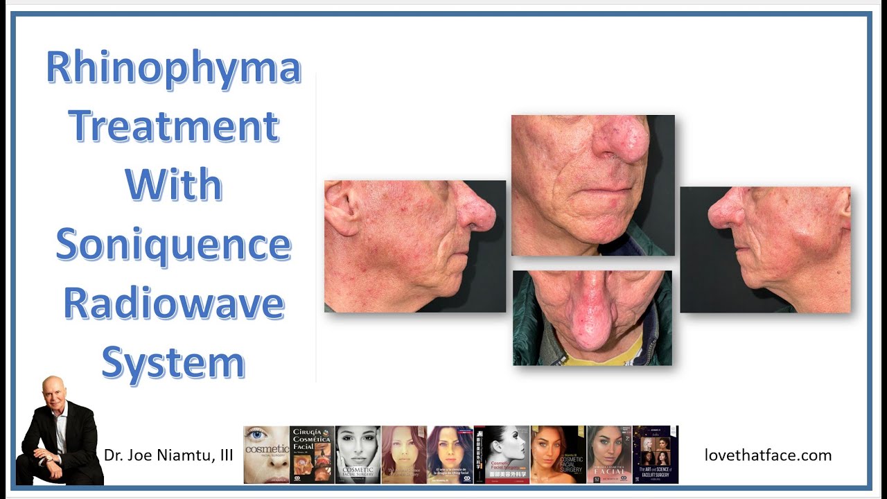 Rhinophyma Treatment with Soniquence Radiowave System - YouTube