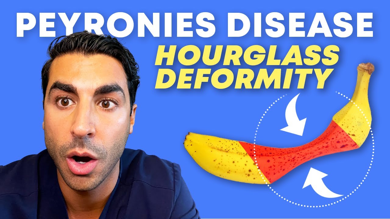 Peyronie’s Disease and Hourglass Deformity | Los Angeles Urology ...