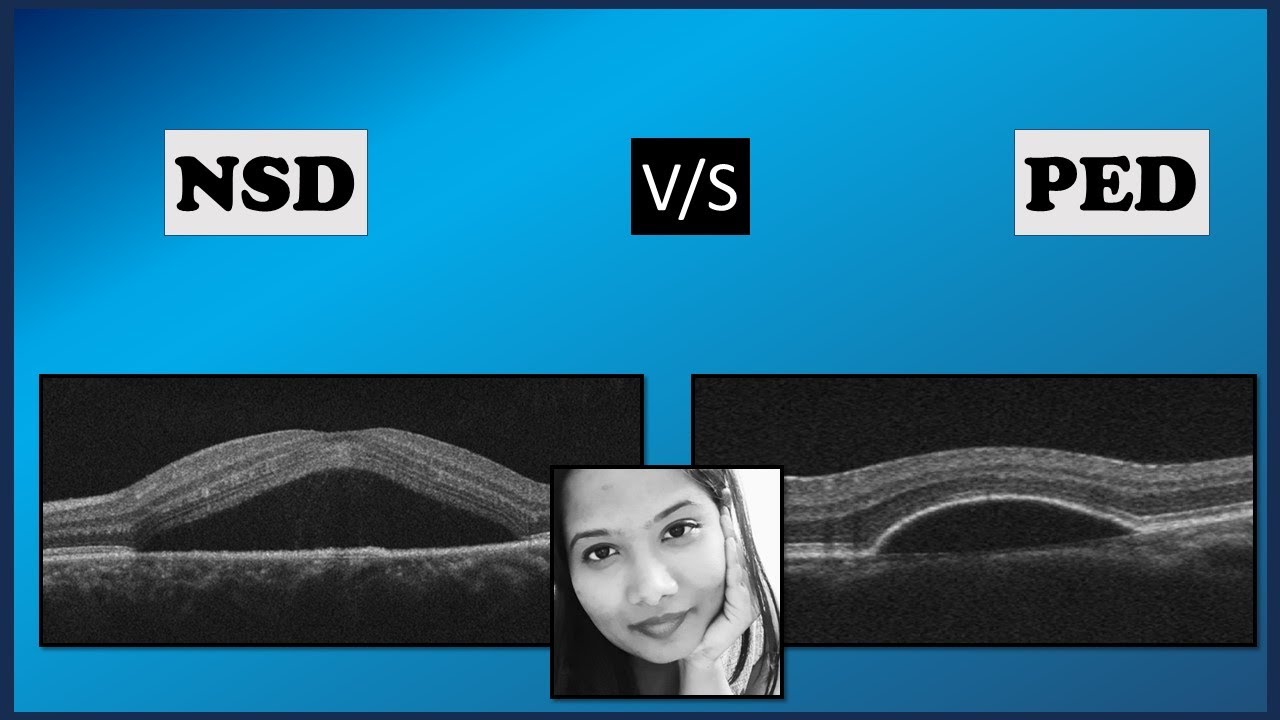 (हिंदी) NSD v/s PED | Retina | OCT - YouTube