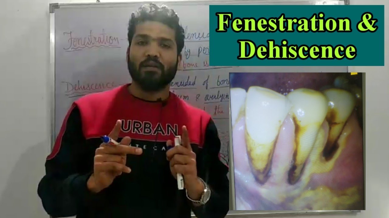 Difference between Fenestration & dehiscence - YouTube