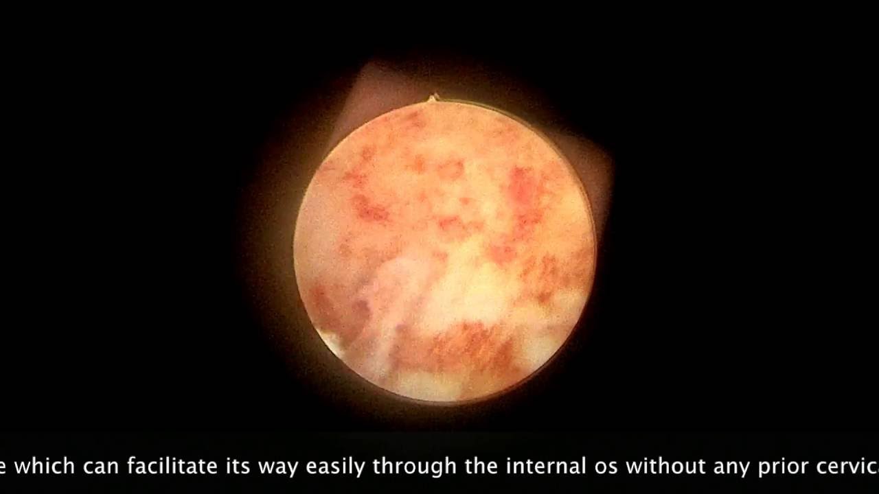 Diagnostic Hysteroscopy - YouTube