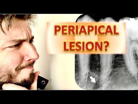 Radiolucency Explained: Spotting the Signs & What it Means! - Wiki ...