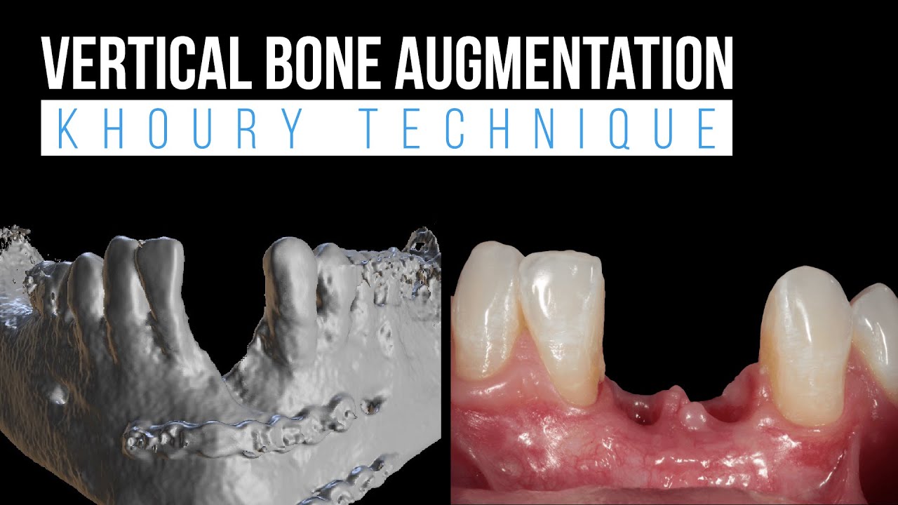 Vertical Bone Augmentation - Khoury Technique - YouTube