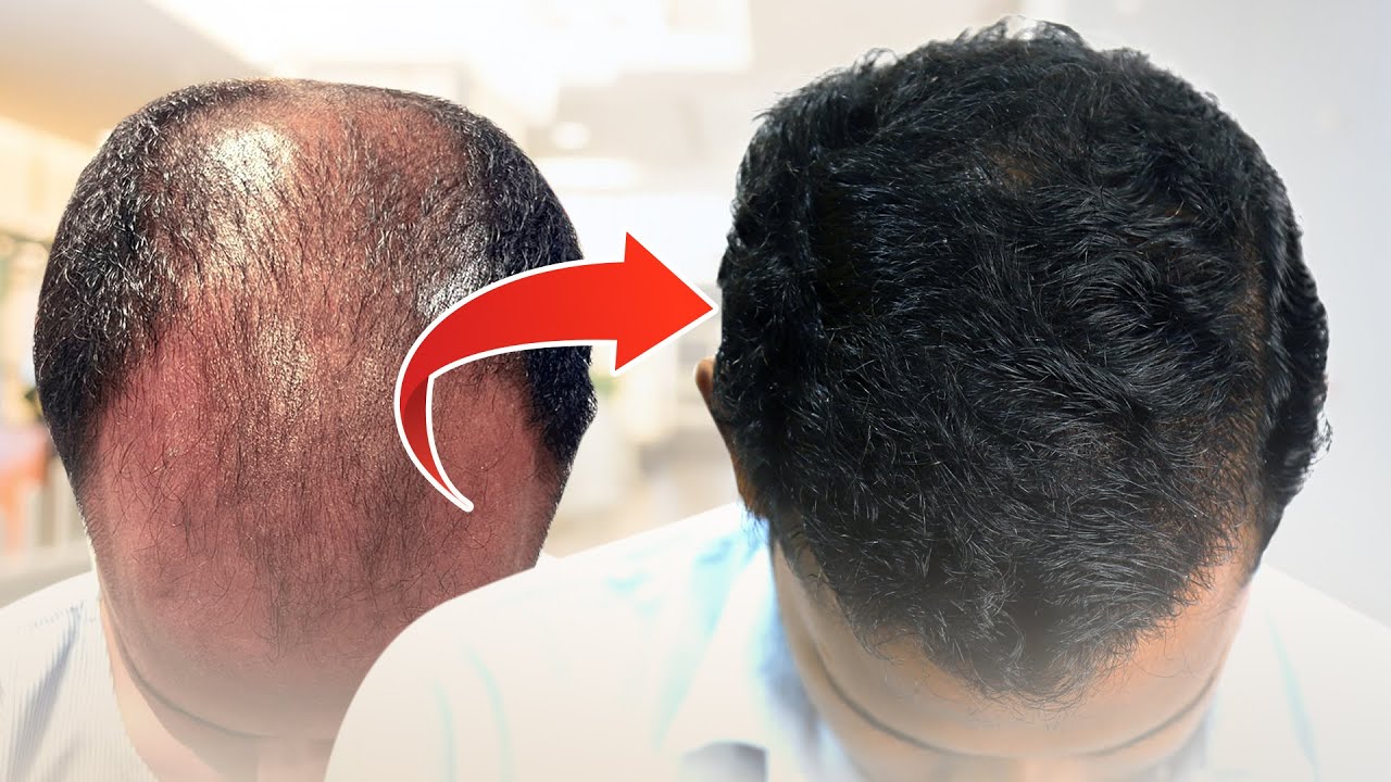 Hair Goals Achieved: Grade 6 Baldness Transformed 😮 | Hair Transplant ...