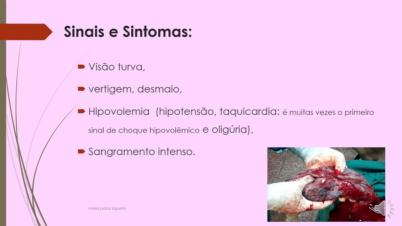 Hemorragia pós parto - video n. 2. #emergenciaobstetrica. - YouTube