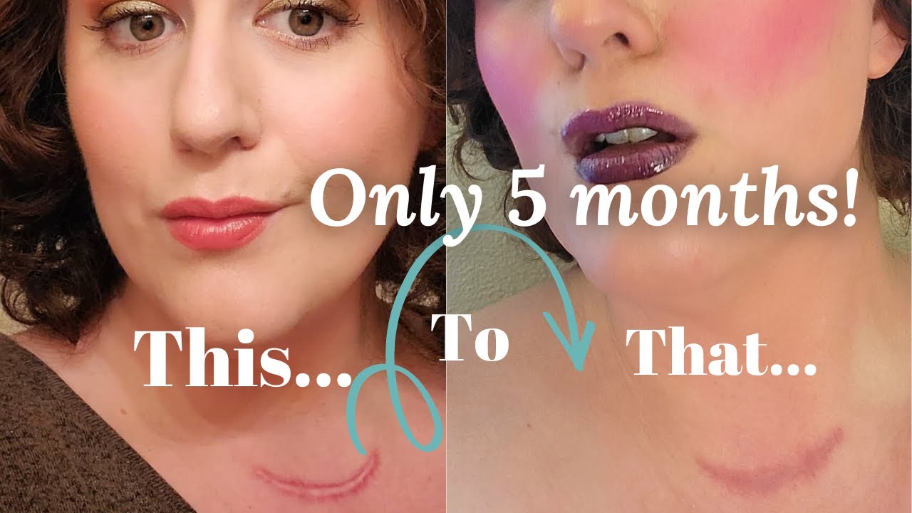 HOW TO GET RID OF RAISED SURGERY SCARS AT HOME / Products I Used To ...