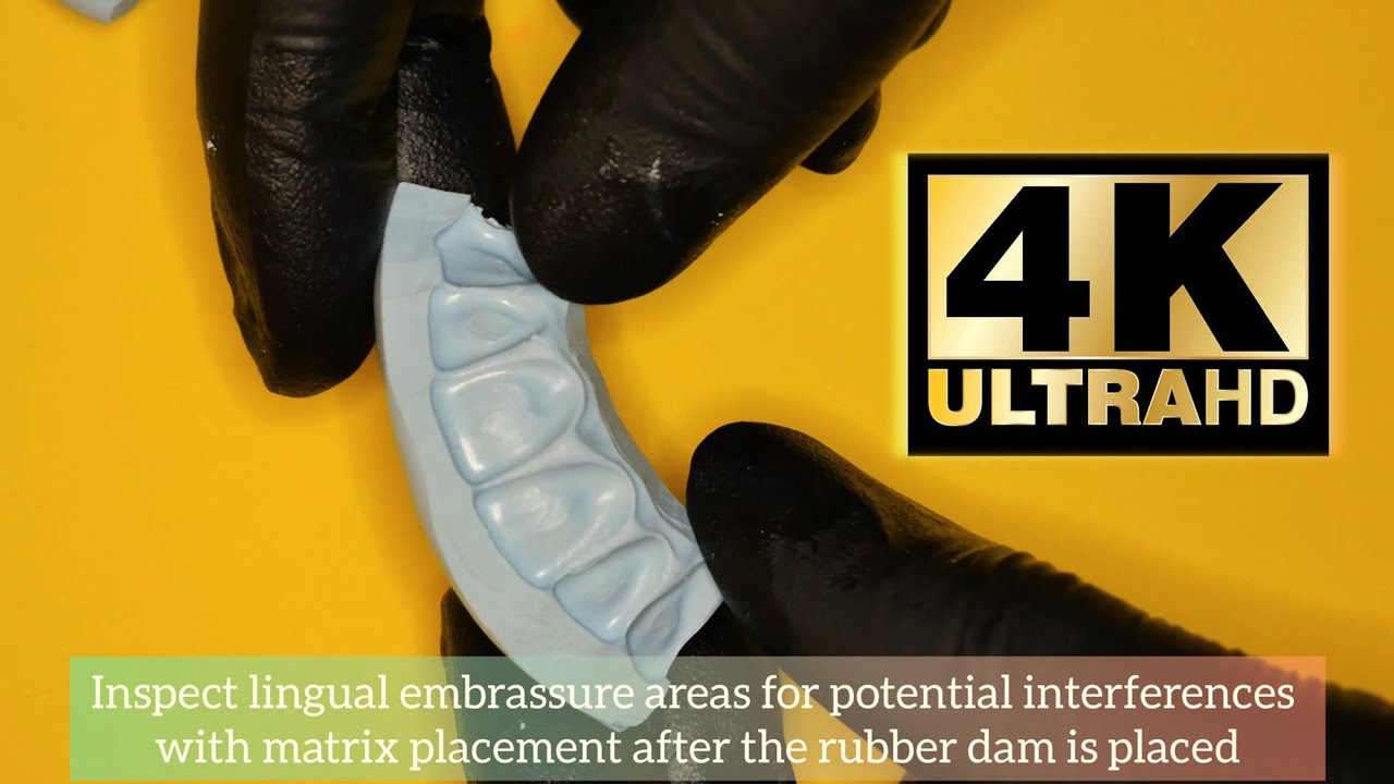 This is how to create a lingual silicon matrix for class IV ...