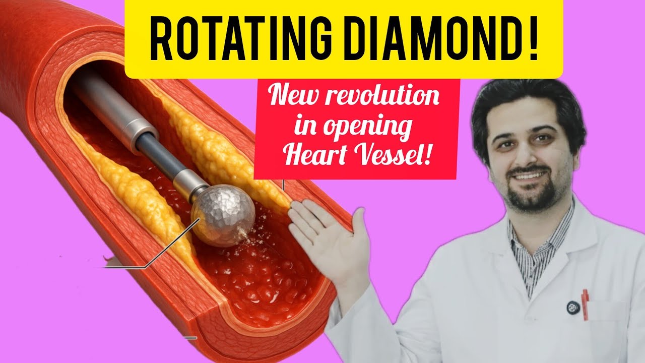 Drilling Through Heart Blockages: What Is a RotaBlator & How It Saves ...