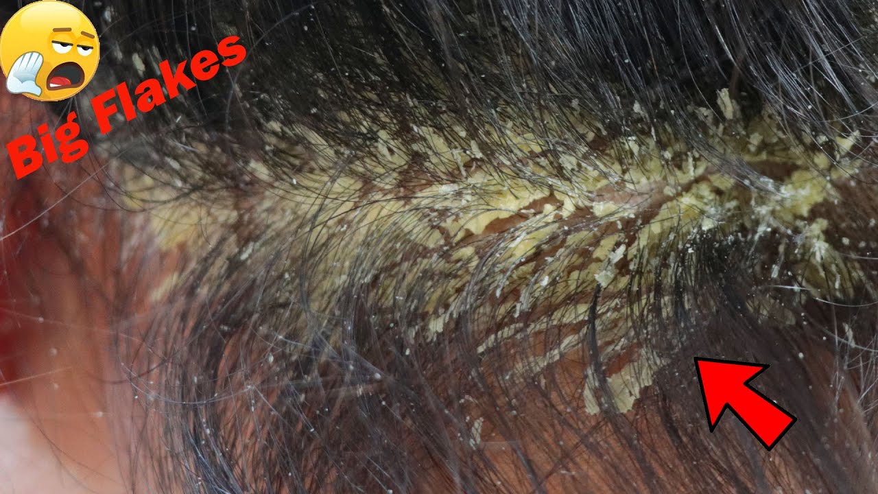 Scratching Huge Flakes Behind Ear On Back Side of Head # 910 - YouTube
