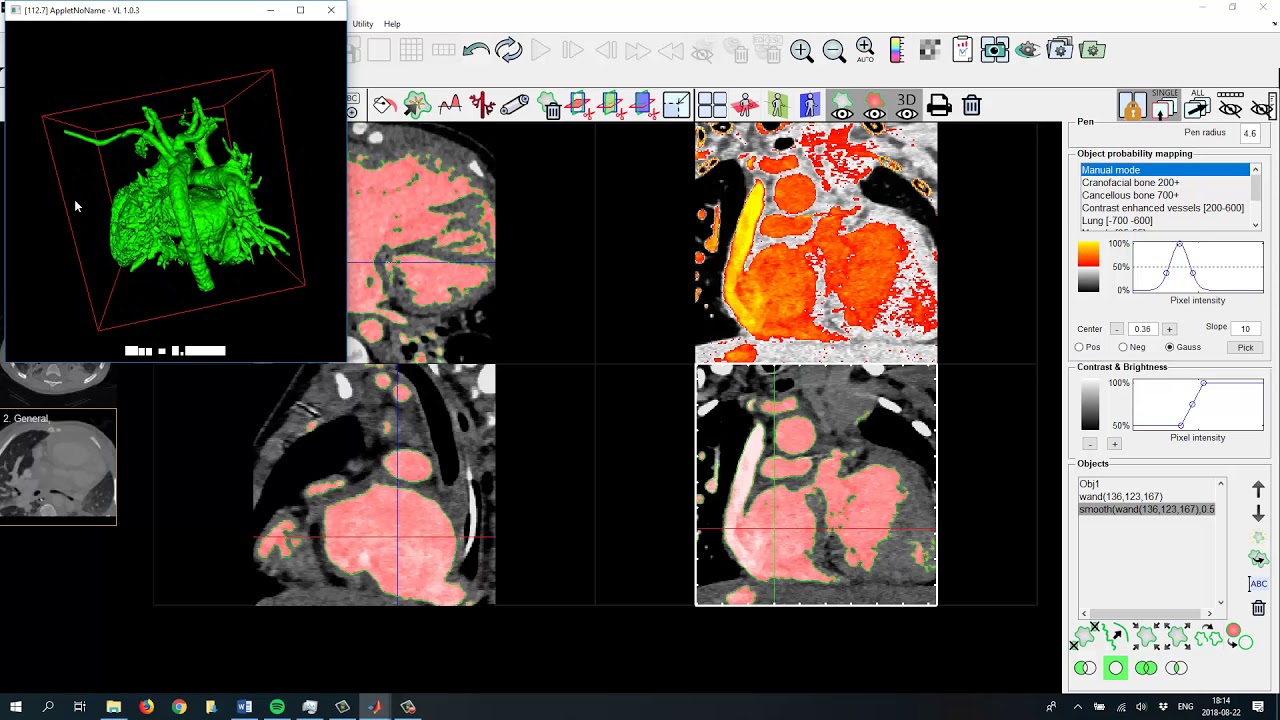 Segmentazione clinica e stampa 3d - Medviso 3DPrint - Introduzione - YouTube