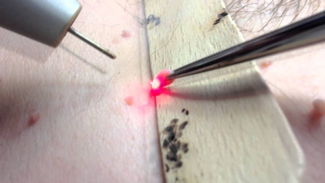 EXCROISSANCE, MOLLUSCUM au LASER - YouTube