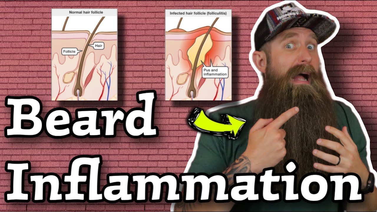 Beard Inflammation - Causes & Solutions! Explained - YouTube