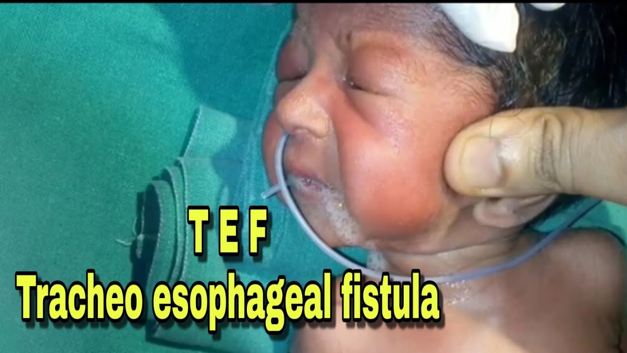 Tracheoesophageal Fistula in a newborn || TEF in a newborn due to ...