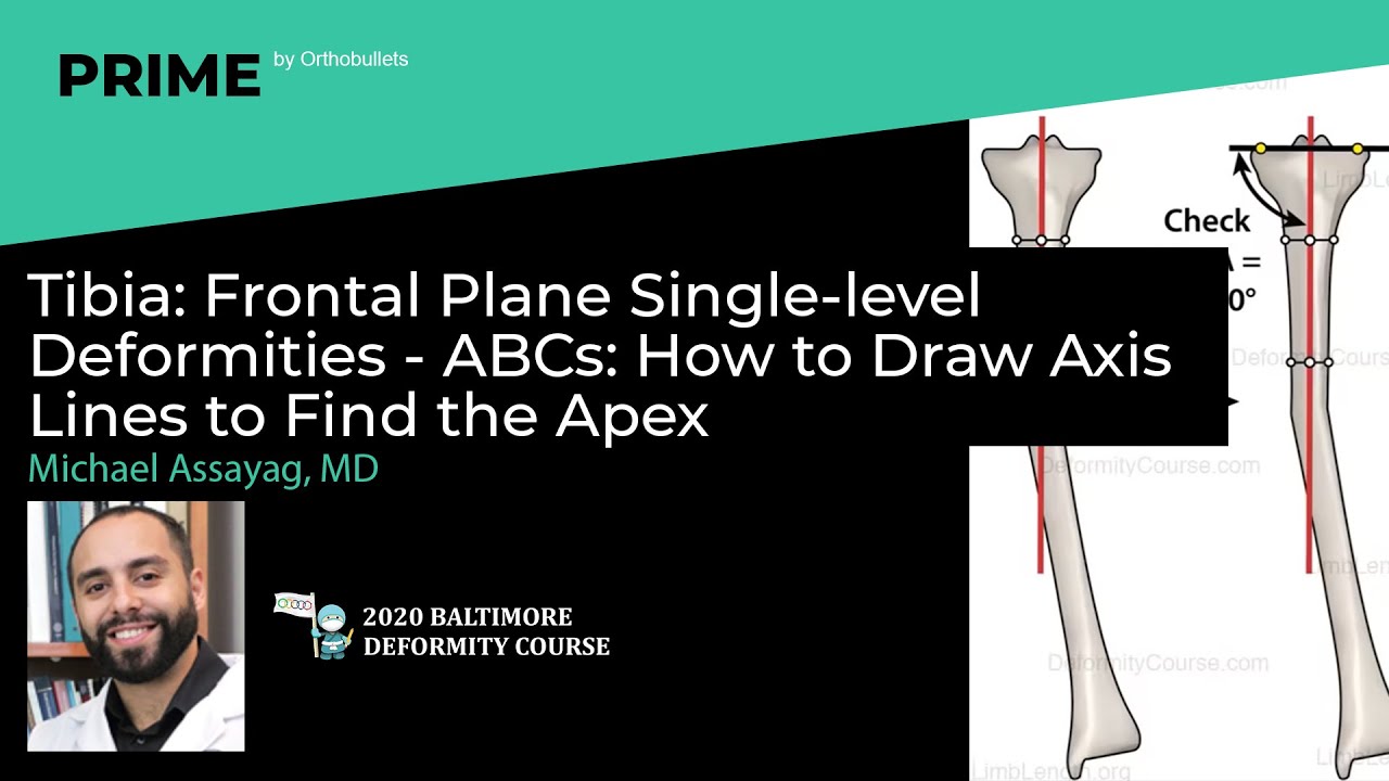 Tibia: Frontal Plane Single-level Deformities - ABCs - Michael Assayag ...
