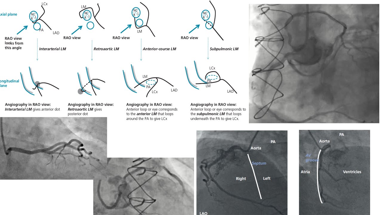 Coronary artery anomalies: angiography, case illustrations, and ...