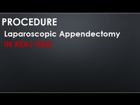 Laparoscopic Appendectomy (IN REAL TIME) - YouTube